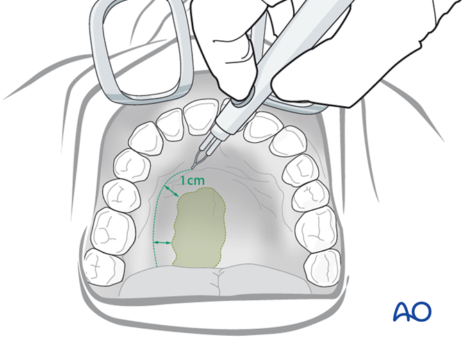 Obturator for Brown I, palate