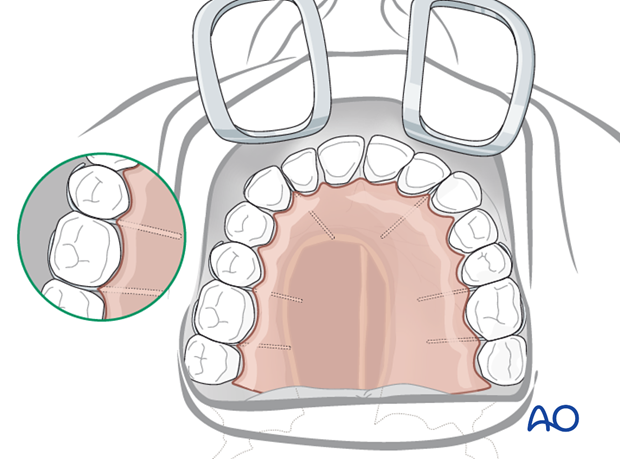 Obturator for Brown I, palate