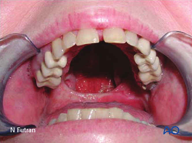 Obturator for Brown I, palate