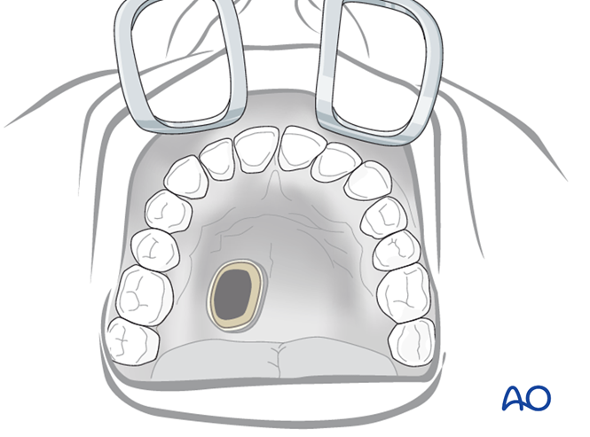 Palatal island flap for Brown I, palate