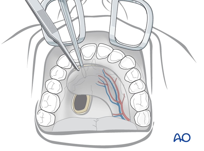 Palatal island flap for Brown I, palate