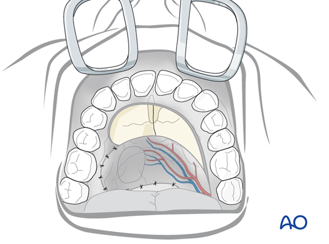 Palatal island flap for Brown I, palate