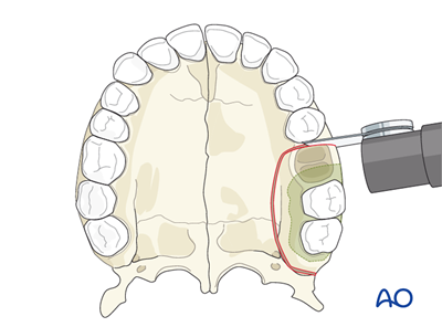 Temporalis muscle flap for Brown I, alveolus