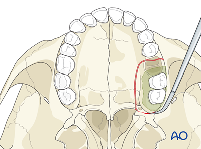 Temporalis muscle flap for Brown I, alveolus