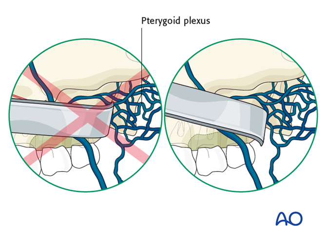 Temporoparietal fascia flap for Brown I, alveolus