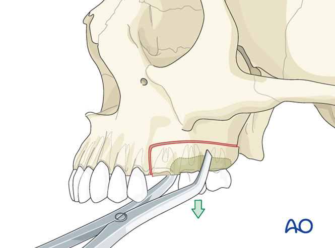 Temporoparietal fascia flap for Brown I, alveolus