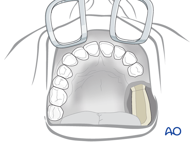Temporoparietal fascia flap for Brown I, alveolus