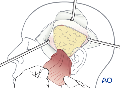 Temporalis muscle flap for Brown I, alveolus