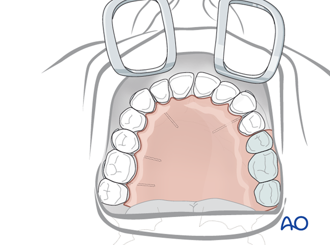 Obturator for Brown I, alveolus