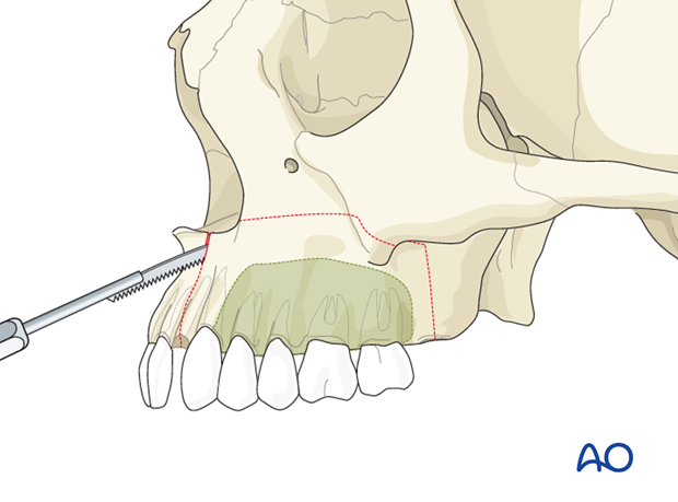 Obturator for Brown II