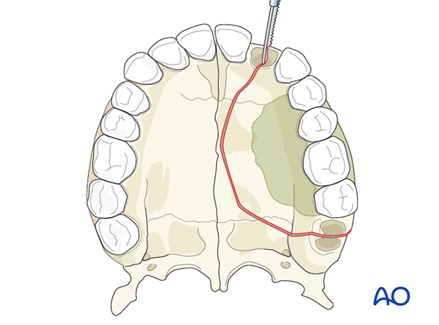 Obturator for Brown II
