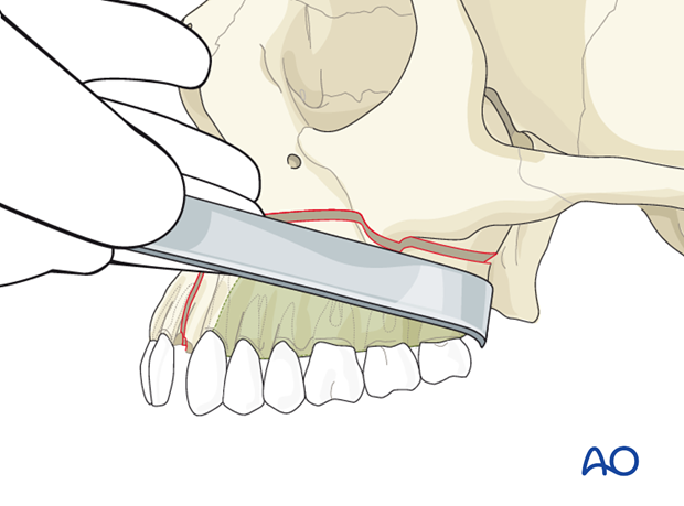Fibular osteocutaneous free flap for Brown II