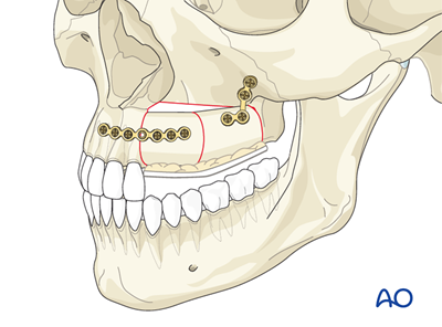 Radial forearm osteocutaneous free flap for Brown II