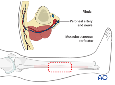 Fibular osteocutaneous free flap for Brown II