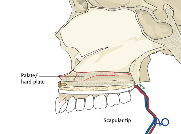 Scapular osteocutaneous free flap for Brown II