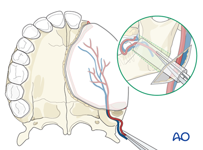 Radial forearm free flap for Alveolar defects in the maxilla