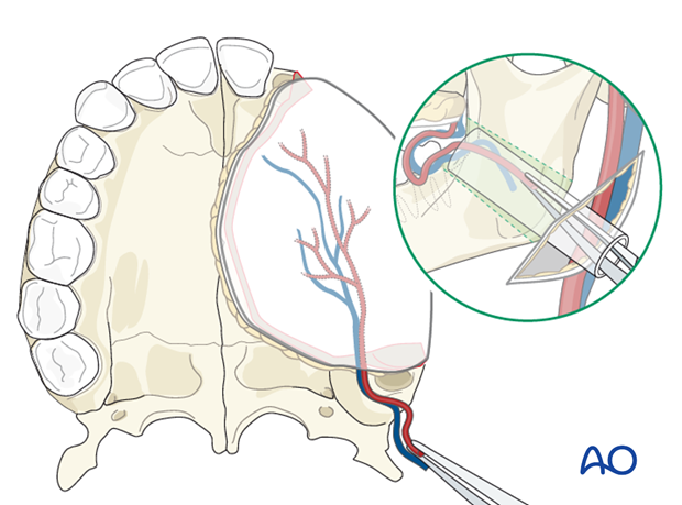Radial forearm free flap for Alveolar defects in the maxilla