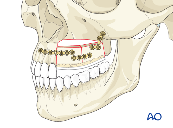Scapular osteocutaneous free flap for Brown II