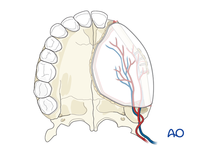 Scapular osteocutaneous free flap for Brown II