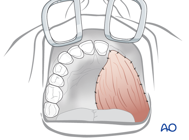 Temporalis muscle flap for Brown II