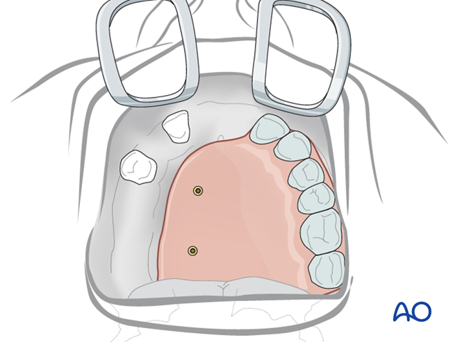 Obturator for Brown II