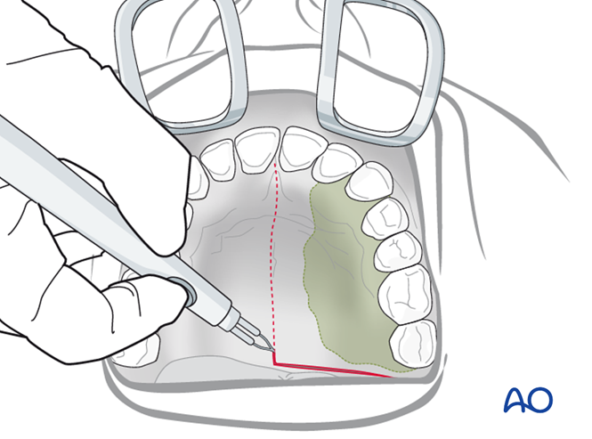 Obturator for Brown III