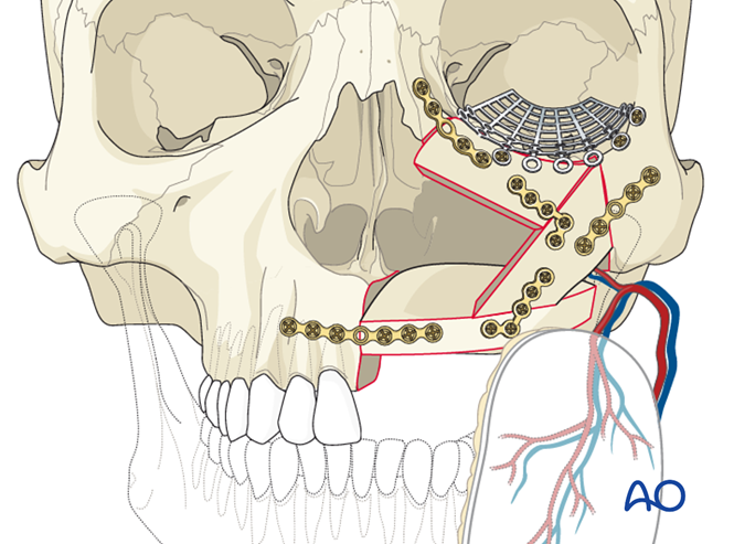 Scapular osteocutaneous free flap for Brown III