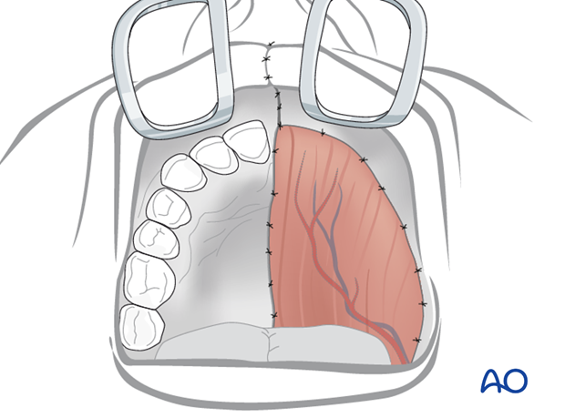 Iliac crest-internal oblique free flap for Brown III