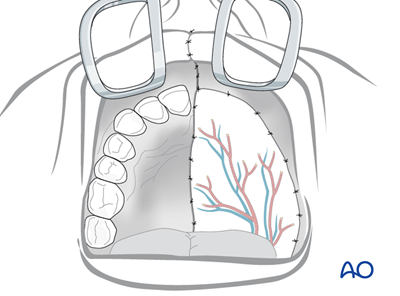 Scapular osteocutaneous free flap for Brown III