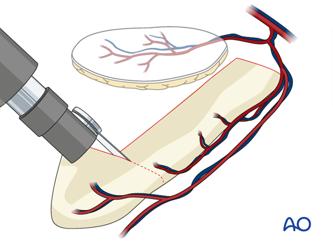 Scapular osteocutaneous free flap for Brown III