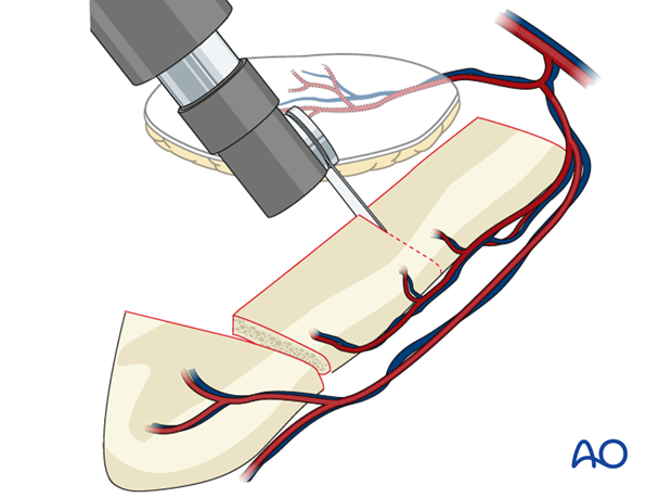 Scapular osteocutaneous free flap for Brown III