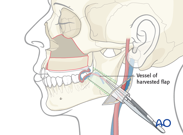 Scapular osteocutaneous free flap for Brown III
