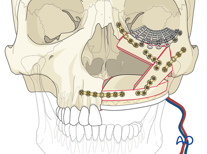 Scapular osteocutaneous free flap for Brown III