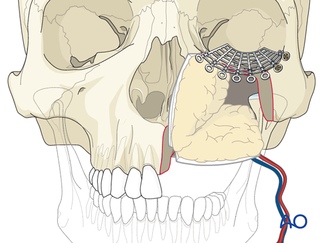 Rectus abdominis fasciocutaneous free flap for Brown III