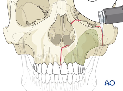 Anterolateral thigh fasciocutaneous free flap for Brown IV