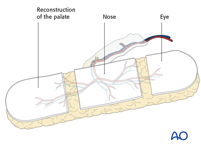 Anterolateral thigh fasciocutaneous free flap for Brown IV