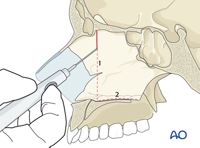 Anterolateral thigh fasciocutaneous free flap for Anterior skull base ...