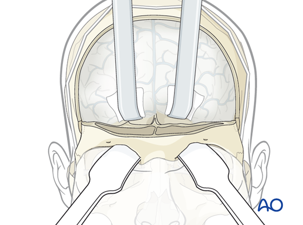 Pericranial flap for Anterior skull base without orbital involvement