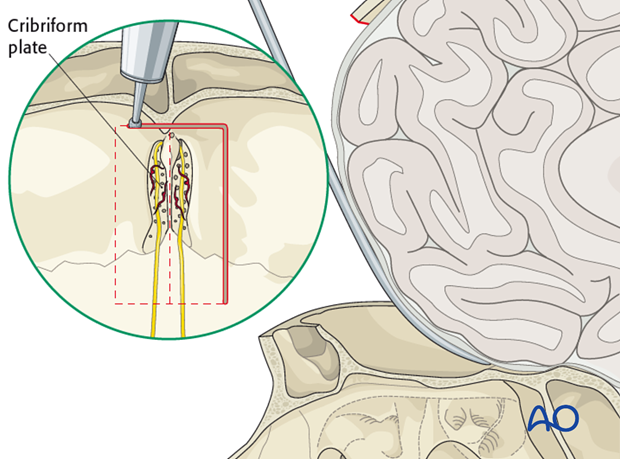 Pericranial and temporoparietal fascia flap for Anterior skull base ...
