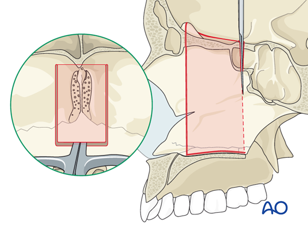 Pericranial flap for Anterior skull base without orbital involvement