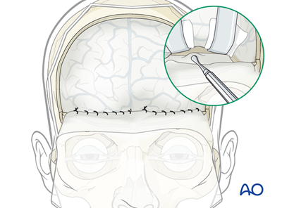 Pericranial flap for Anterior skull base without orbital involvement