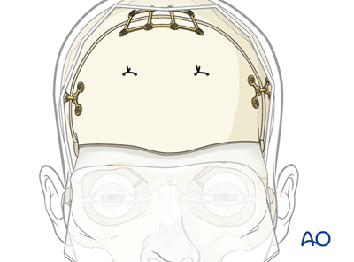 Pericranial flap for Anterior skull base without orbital involvement