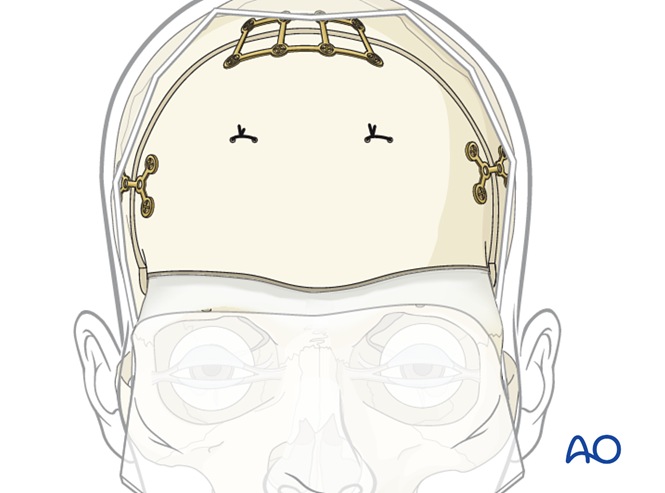 Pericranial flap for Anterior skull base without orbital involvement