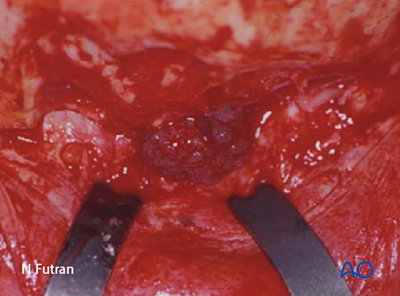 Pericranial flap for Anterior skull base without orbital involvement
