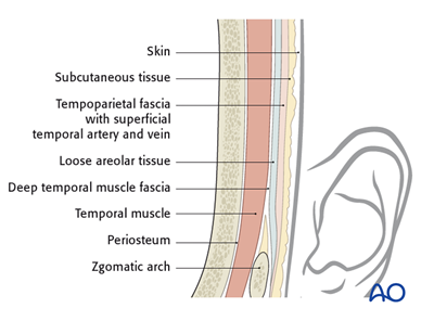 Pericranial and temporoparietal fascia flap for Anterior skull base ...