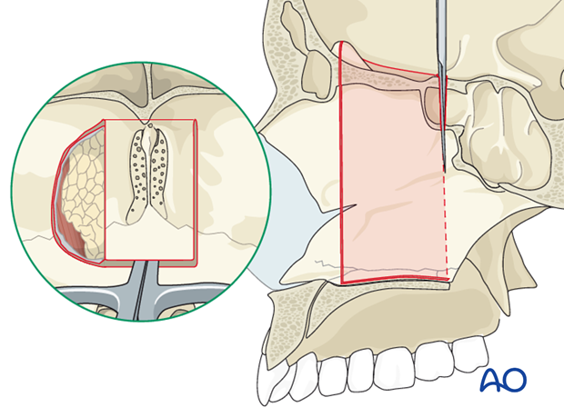 Pericranial and temporoparietal fascia flap for Anterior skull base ...