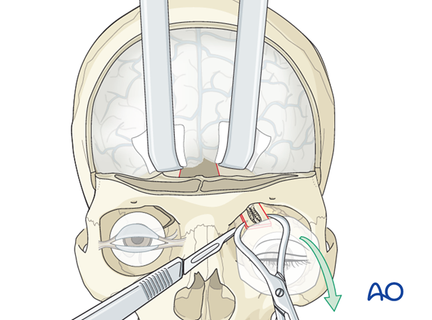 Pericranial and temporoparietal fascia flap for Anterior skull base ...