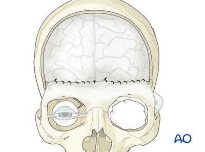 Pericranial and temporoparietal fascia flap for Anterior skull base ...