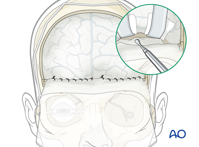 Pericranial and temporoparietal fascia flap for Anterior skull base ...