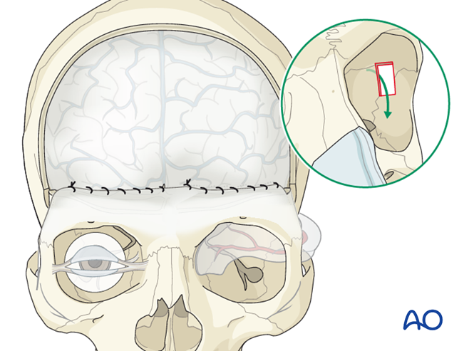 Pericranial and temporoparietal fascia flap for Anterior skull base ...